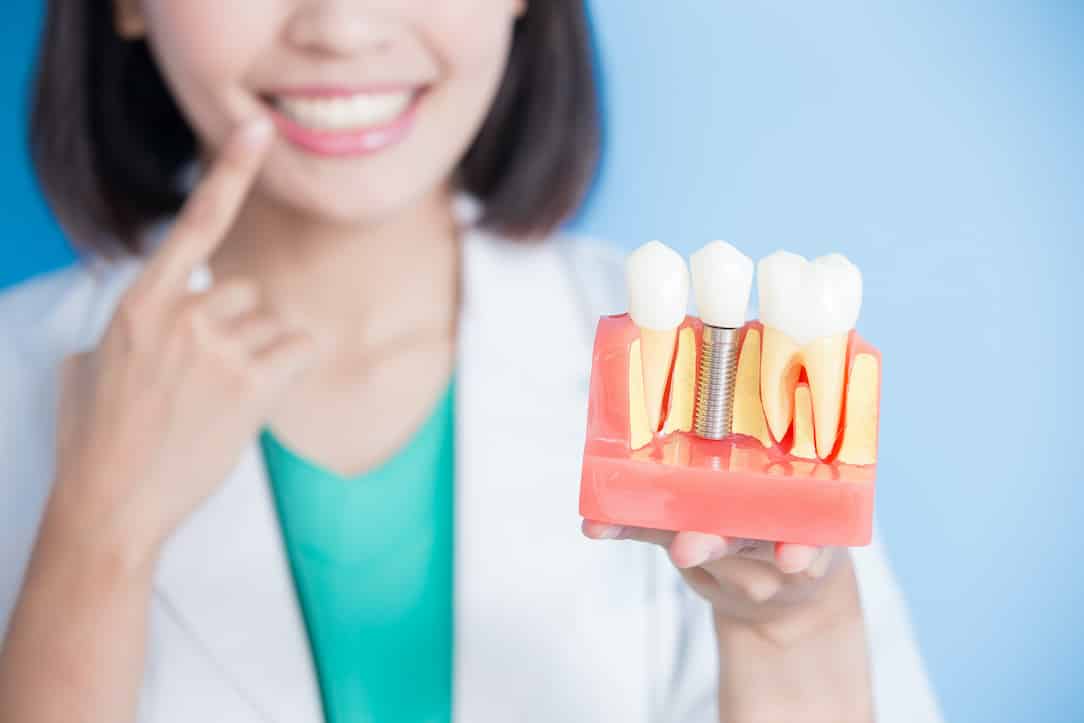 Why Replacing Lost Teeth Is Important: The Benefits of Dental Implants